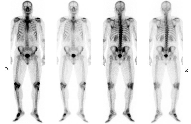 Led research that developed Tc99m-MDP, a short-lived radioactive ...